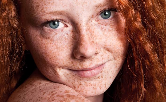 Sardas: o que são e por que aparecem? - Alegrete Tudo