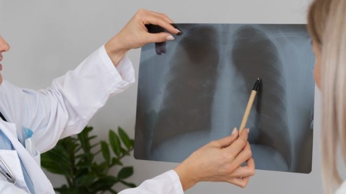 Pessoas diagnosticadas com tuberculose estão sob controle - veja ...